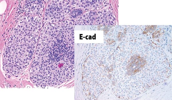 LCIS variants and DCIS: tips on telling them apart - CAP TODAY