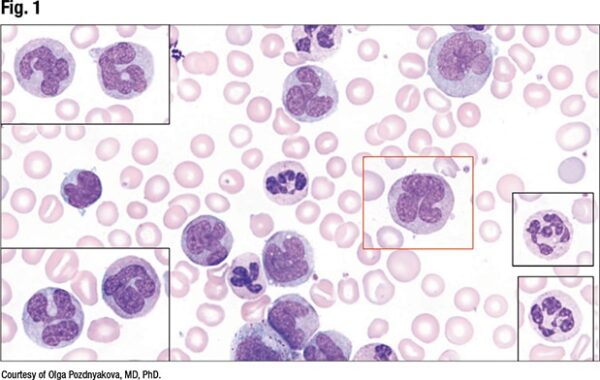 Close-up on abnormal monocyte morphology in peripheral blood smears ...