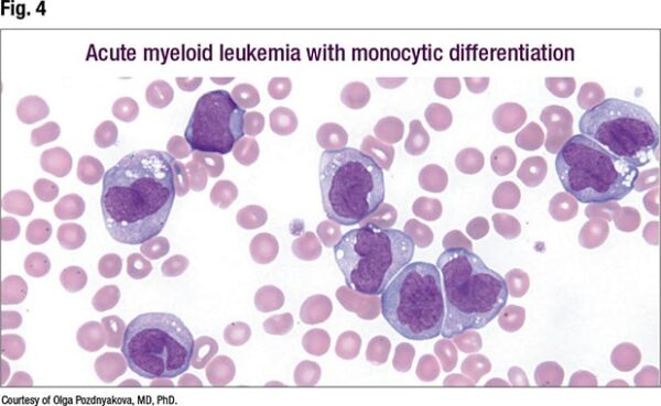 Close-up on abnormal monocyte morphology in peripheral blood smears ...