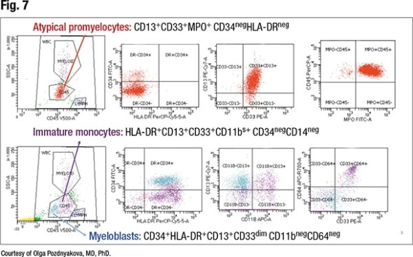 Close-up on abnormal monocyte morphology in peripheral blood smears ...