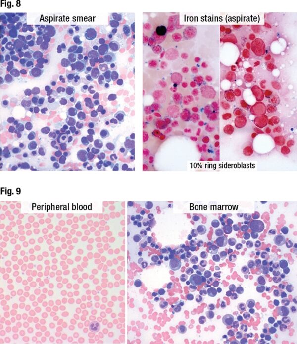 Integrating NGS into the cytopenia workup - CAP TODAY