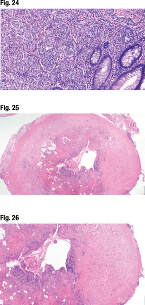 Appendiceal lesions: features, subtypes, patterns - CAP TODAY