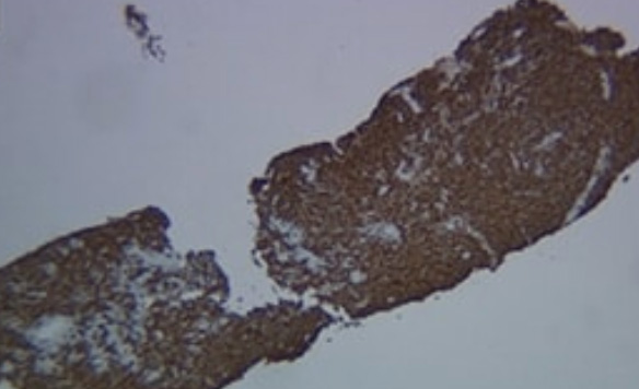 Use of molecular techniques to solve a challenging case of primary ...